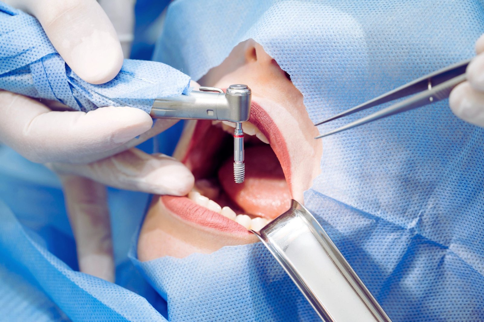 Pivot Implants Blog – Insights, Trends & Dental Innovation