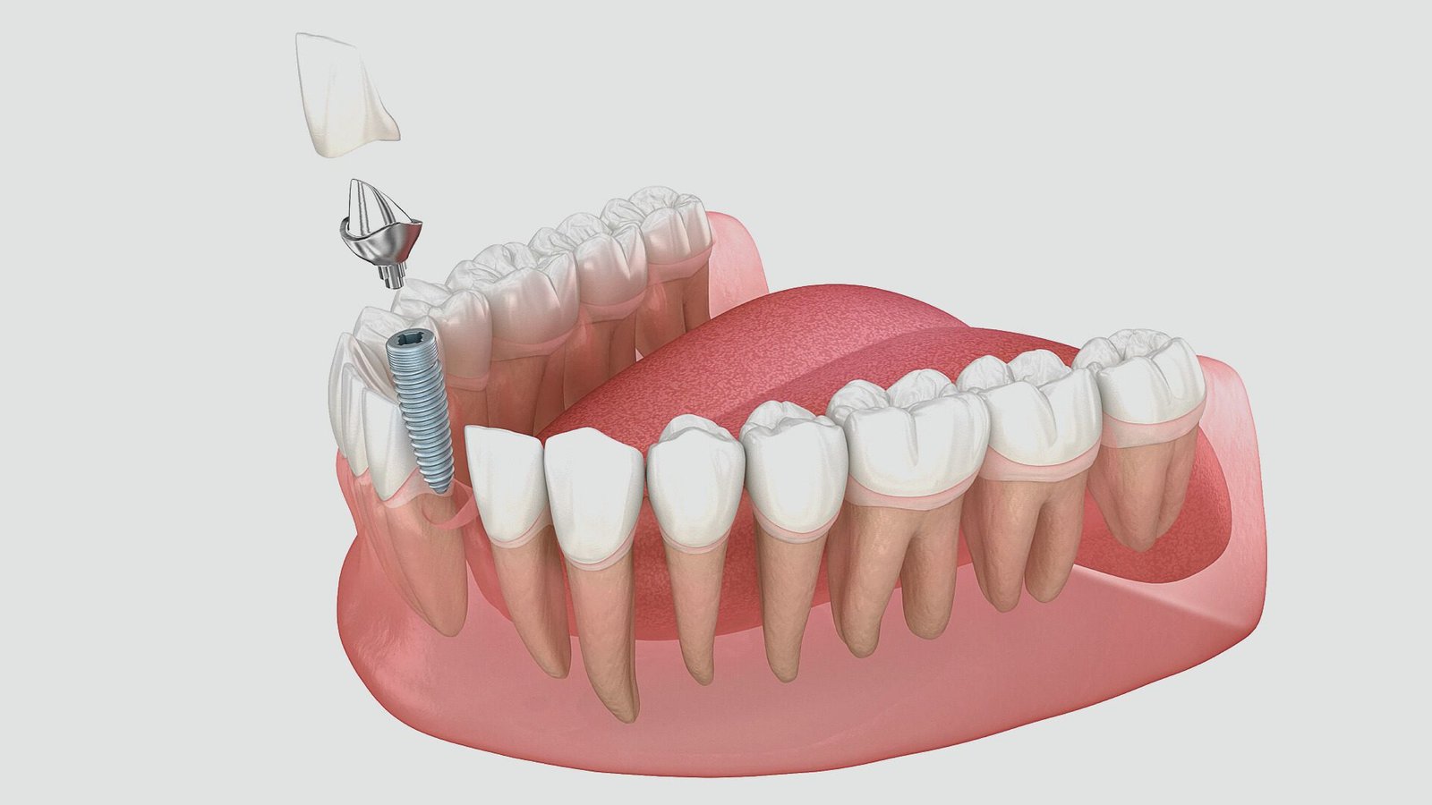 Surgical Tool Kit Manufacturer In USA | Pivot Implants
